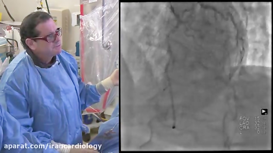Three Vessel PCI Versus Bypass Surgery Reduced to One Vessel PCI