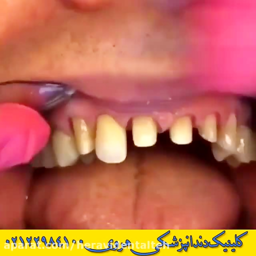 آخرین مرحله و نصب روکش دندان