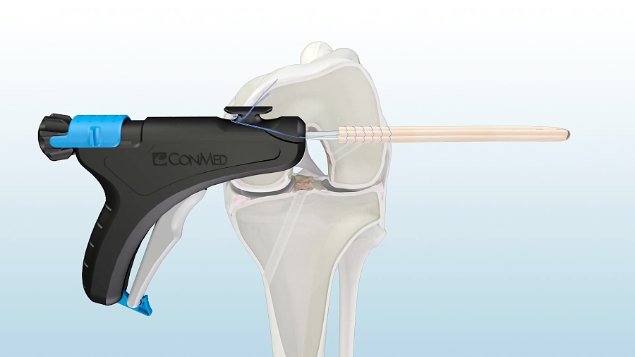 Soft Tissue ACL Reconstruction Using the ExoShape