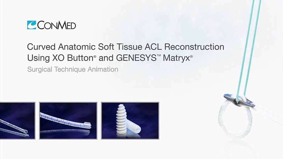 Curved Anatomic Soft Tissue ACL Reconstruction Using XO Button