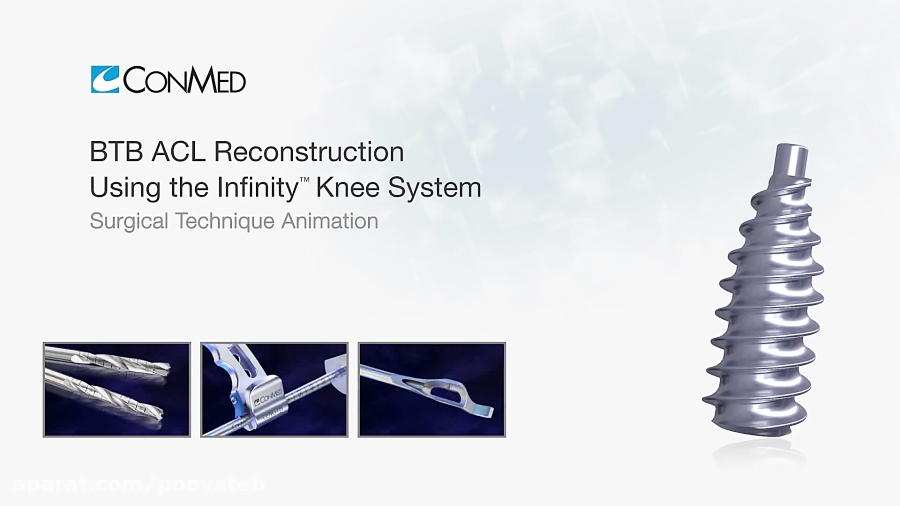 BTB ACL Reconstruction Using the Infinity™ Knee System