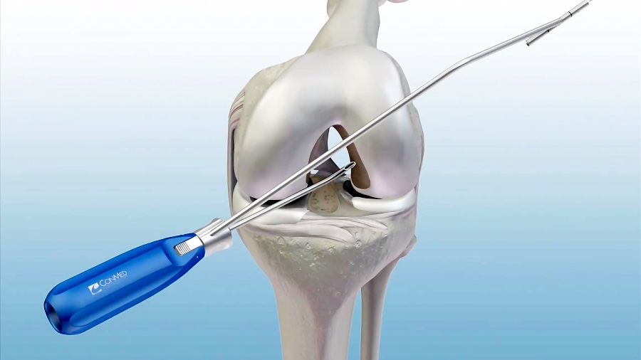 Curved Anatomic BTB ACL Reconstruction Using the GraftMax System