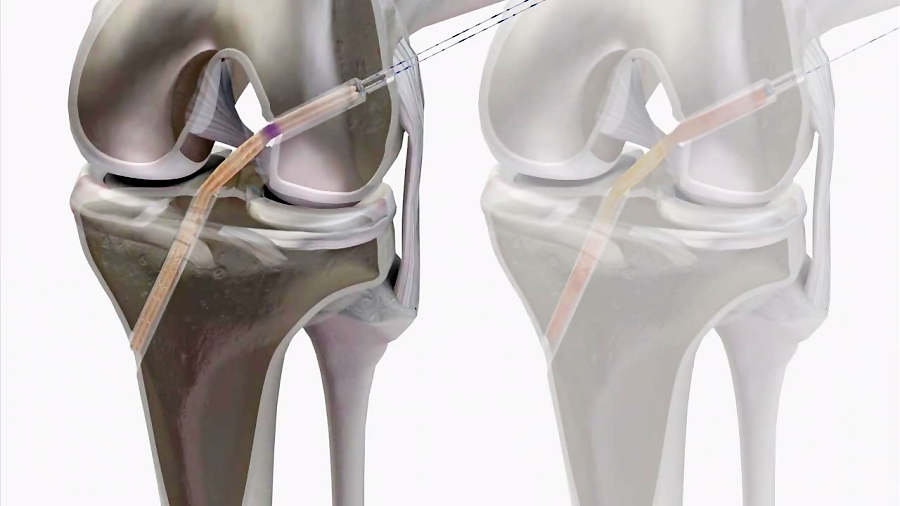 Curved Anatomic BTB ACL Reconstruction Using GENESYS Matryx