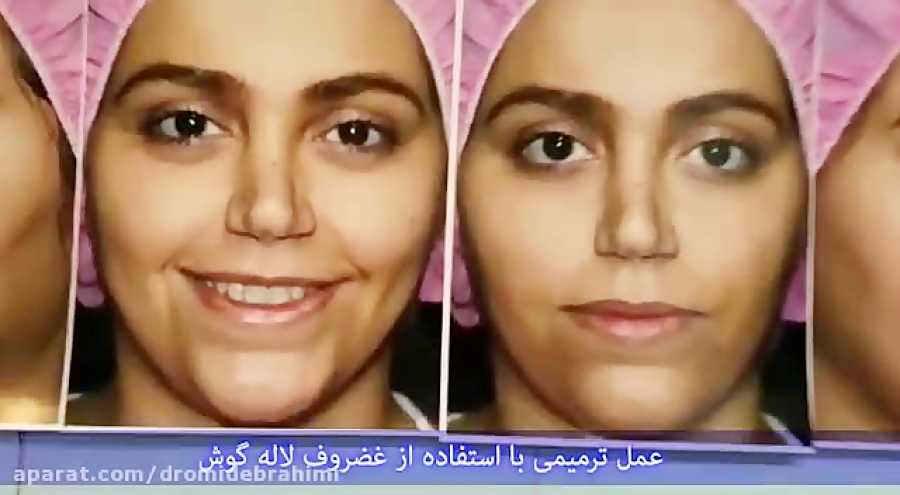 جراحی ترمیم بینی با استفاده از غضروف لاله گوش توسط دکتر امید ابراهیمی