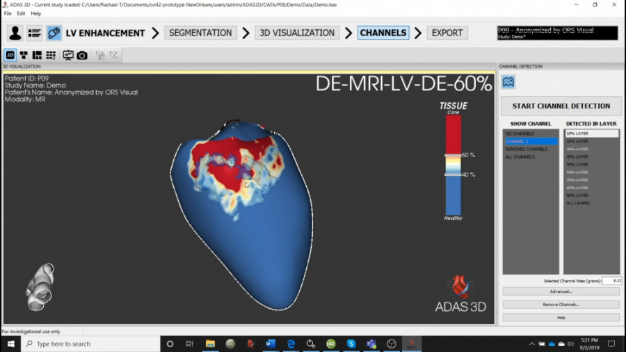 Electrophysiology ADAS 3D LV - Cardiac MRI and CT Software cvi42.ir