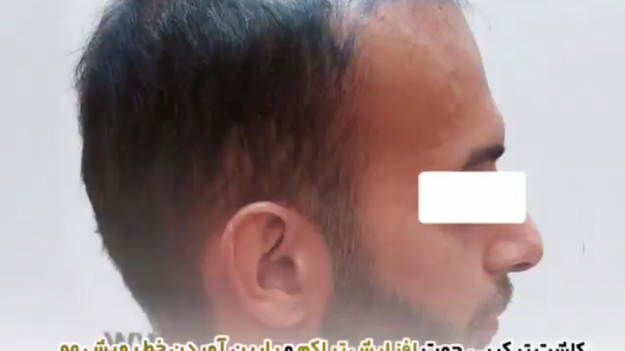 کاشت مو کلینیک تخصصی کاشت موی بهبد