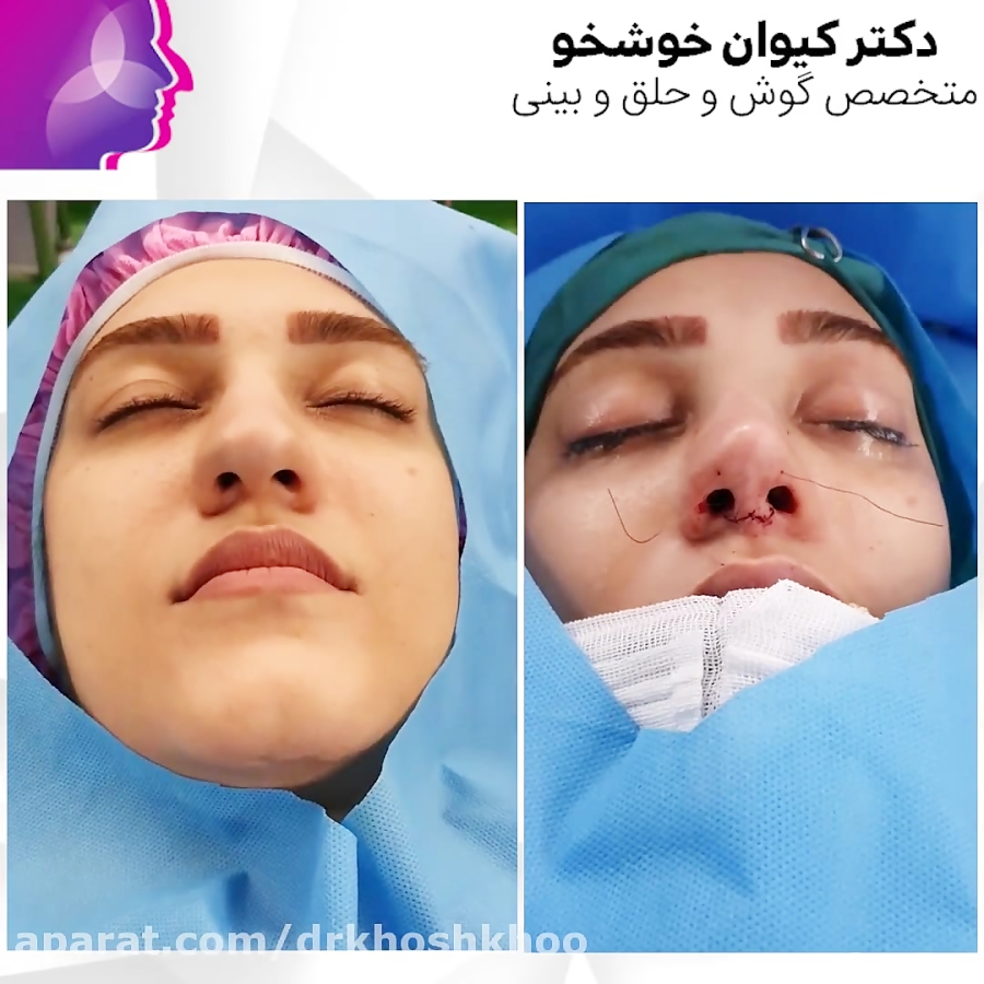بلافاصله پس از جراحی زیبایی بینی