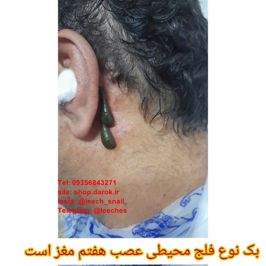 زالو درمانی فلج بلز