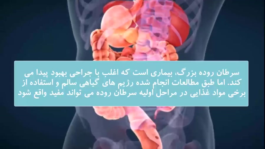 سرطان روده چیست؟ به آیند
