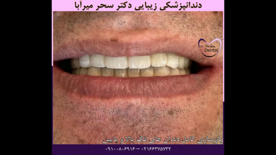 بازسازی کامل دندان های فک های بالا و پایین