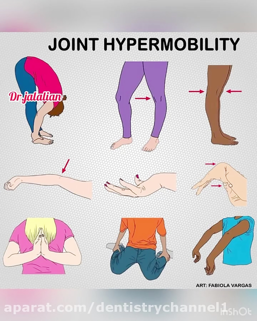 hypermobile joints and joint hypermobility syndrome ( دکتر جلالیان )