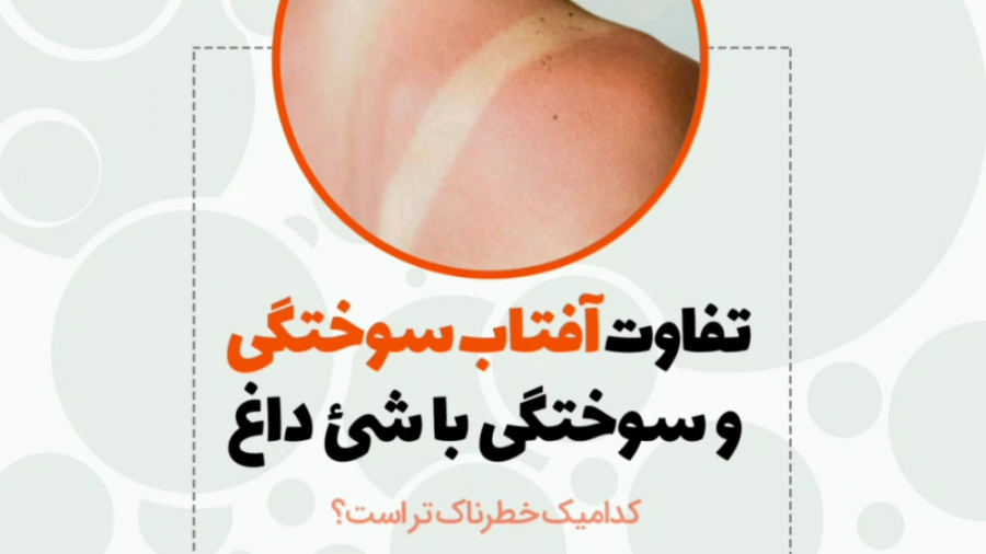 تفاوت آفتاب سوختگی با سوختگی با یک شی داغ