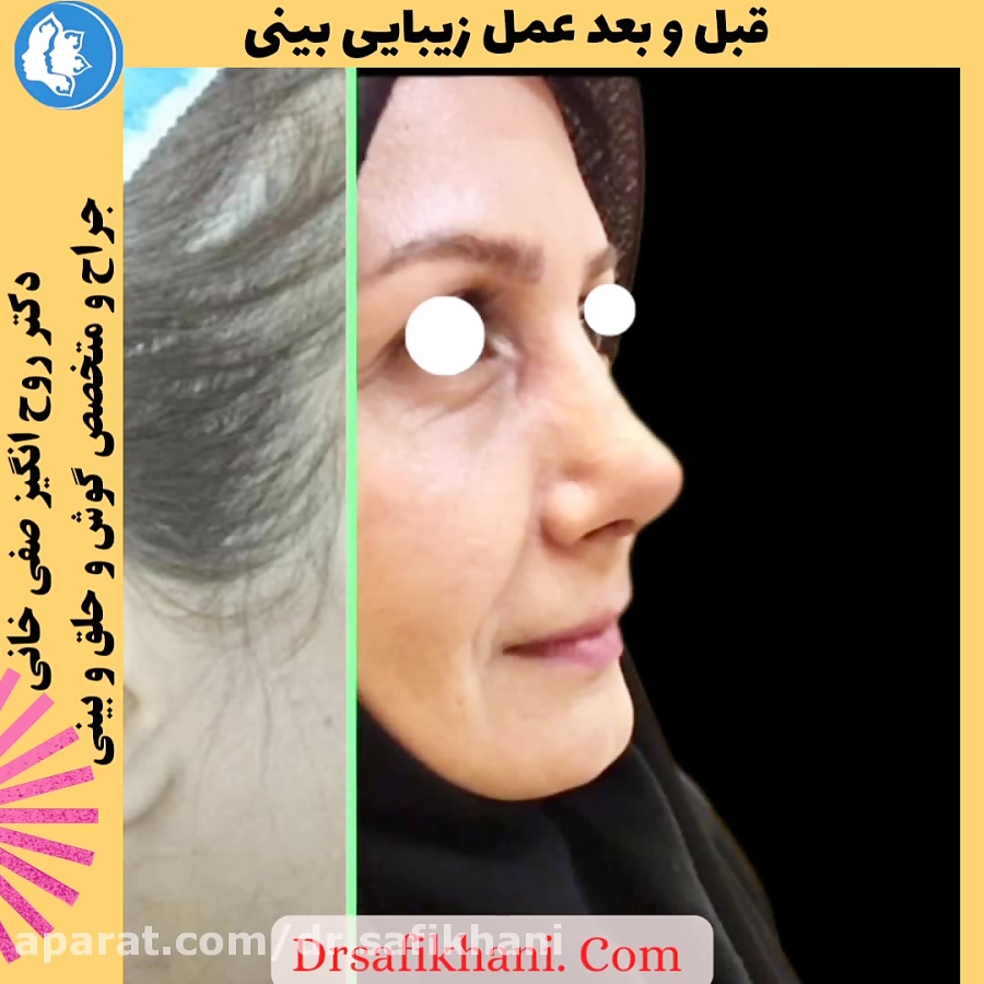 جراحی زیبایی بینی رینوپلاستی دکتر روح انگیز صفی خانی