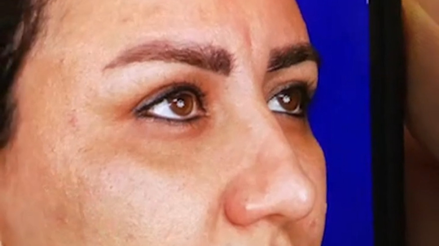 جراحی ترمیم بینی با غضروف دنده