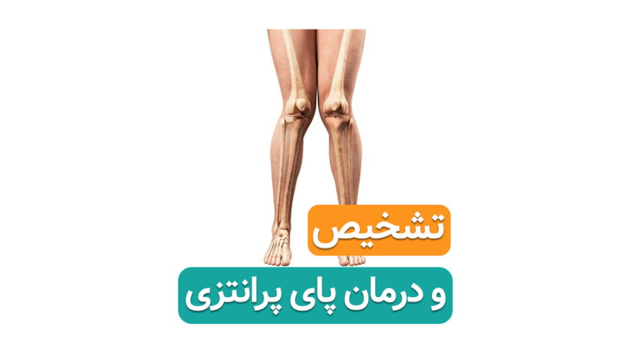 تشخیص و درمان زانوی پرانتزی دکتر محمدرضا صادقی جراح ارتوپد
