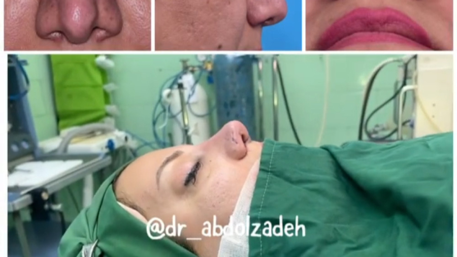 عمل ترمیمی بینی با غضروف دنده