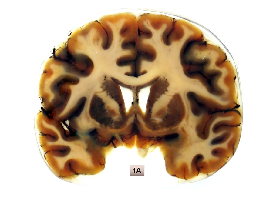 Brain plastination 1