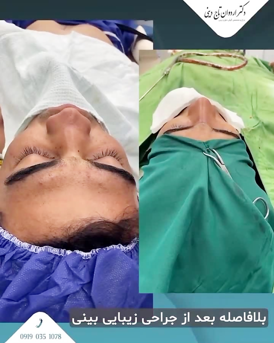 بلافاصله بعد از جراحی زیبایی بینی با استفاده از غضروف دنده