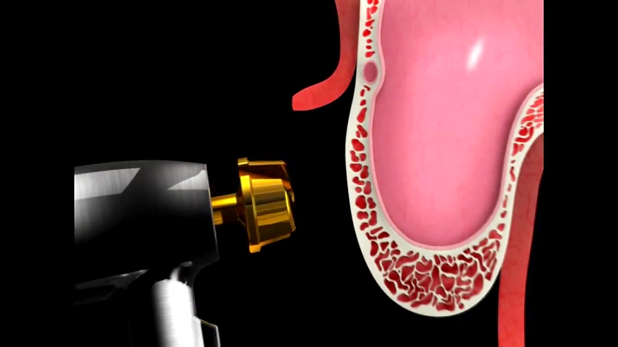Neobiotech Sinus Lift Solution - SCA Kit (LS Reamer)