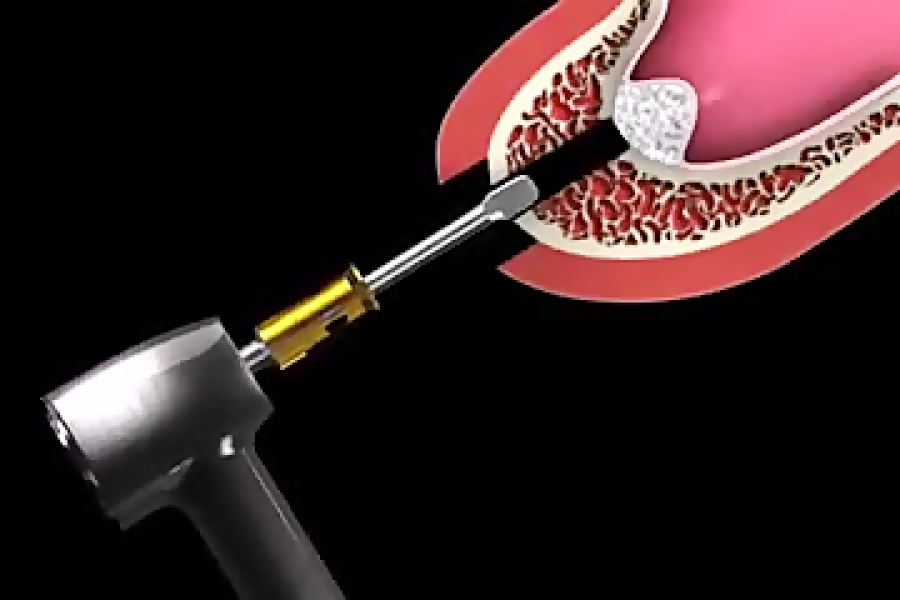 Neobiotech Sinus Lift Solution - SCA Kit (Bone Spreader)