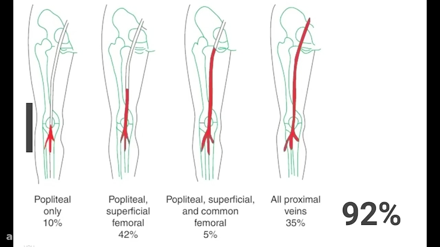 A quick assessment of DVT in emergency setting